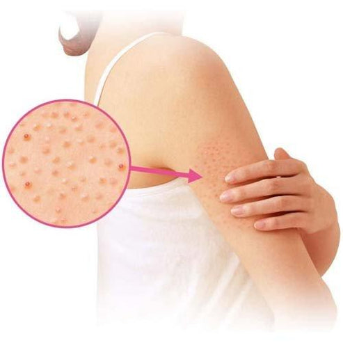 小林製藥 NinoCure 尿素角質軟化軟膏 30g[第3類醫藥品] – 小熊藥妝 - 日本藥妝直送台灣